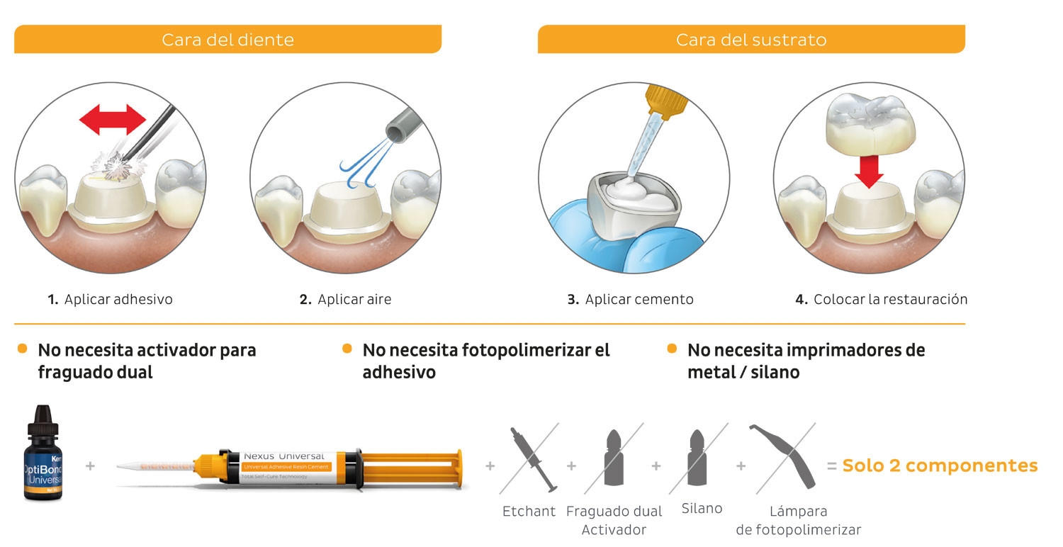 Nexus™ Universal Cemento universal de resina adhesiva | Kerr Dental